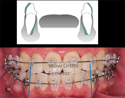 Orthodontic Biomechanics course - Wow Ortho Seminar