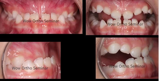 Anterior crossbite treatment in children - Wow Ortho Seminar