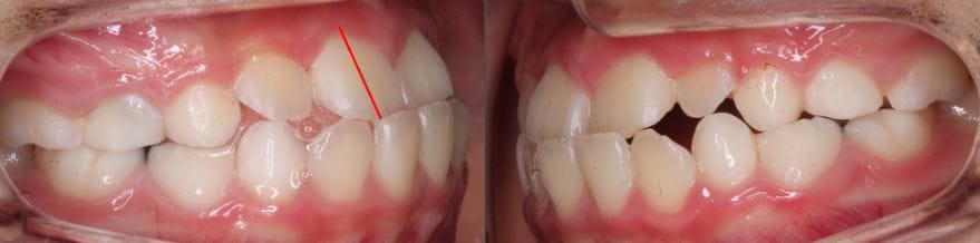 Anterior crossbite treatment in children - Wow Ortho Seminar