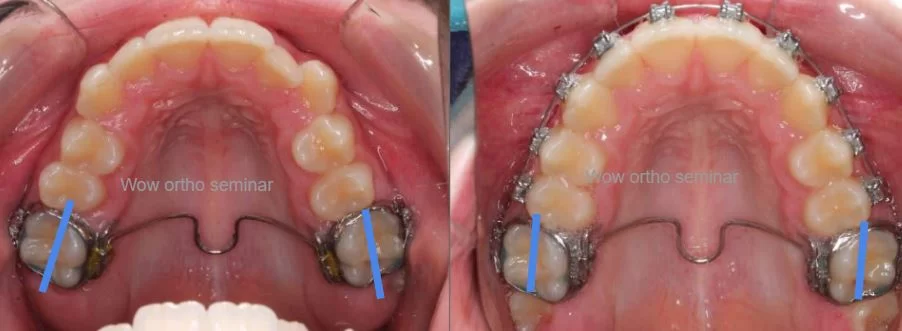 Orthodontic Biomechanics course - Wow Ortho Seminar