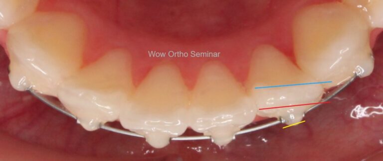 Wrong bracket positioning - Wow Ortho Seminar Wrong bracket positioning - Wow Ortho Seminar