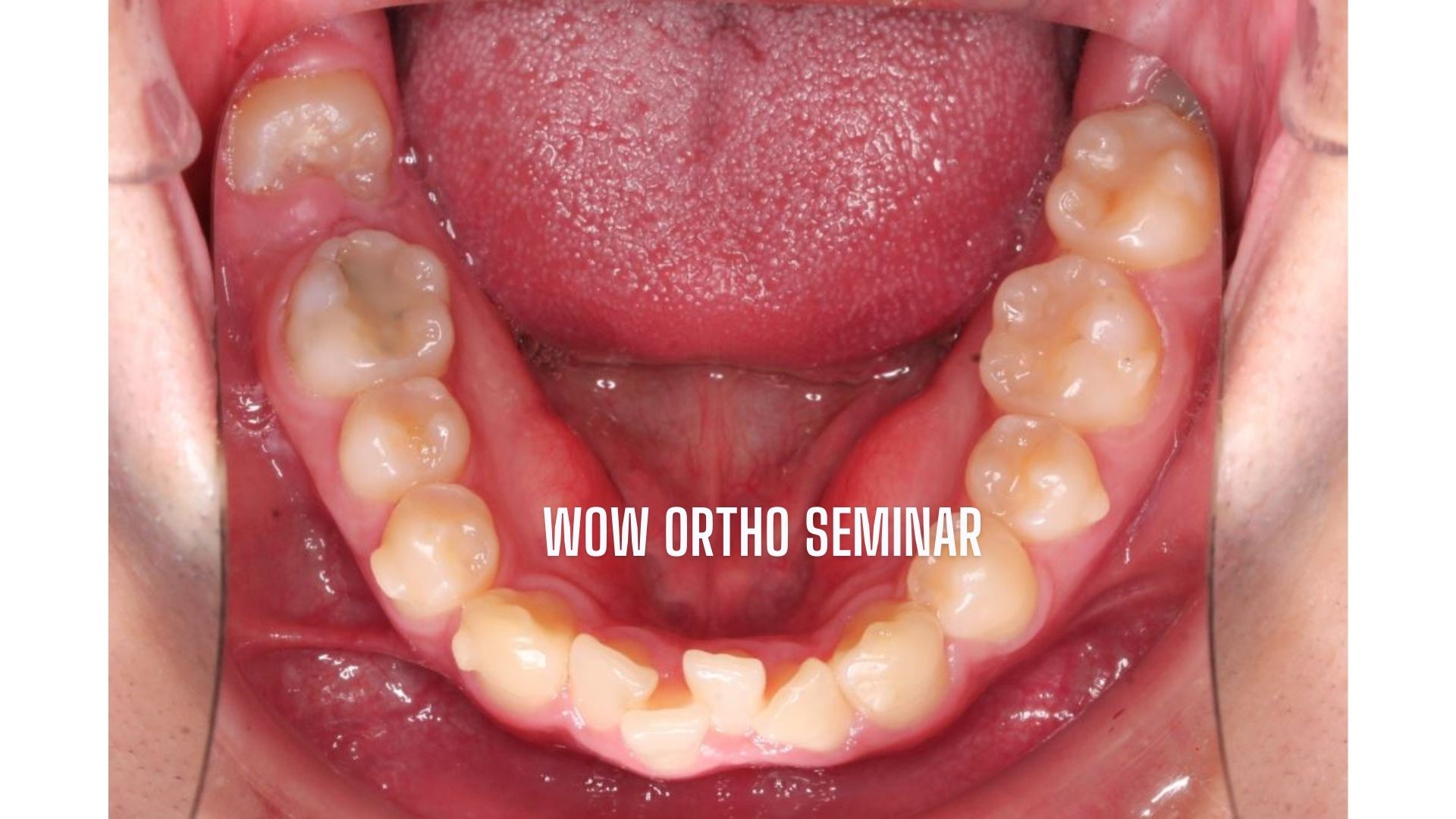 How to Replace 2nd molar with wisdom tooth - Wow Ortho Seminar