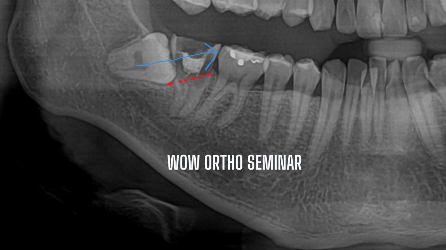 How to Replace 2nd molar with wisdom tooth - Wow Ortho Seminar