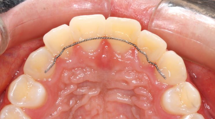 What if a new patient wants fixed retainer repair or remake? - Wow ...